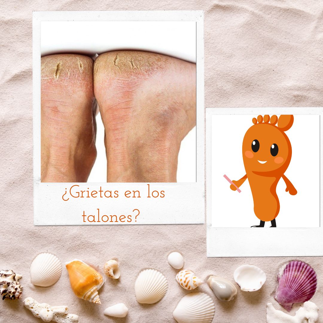 GRIETAS EN LOS TALONES. CAUSAS Y CONSEJOS PARA EVITARLAS. - Podólogo ...